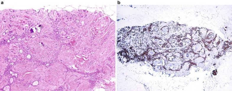 Adenosis, Sclerosing Lesions, Microglandular Adenosis, and Mucocele ...