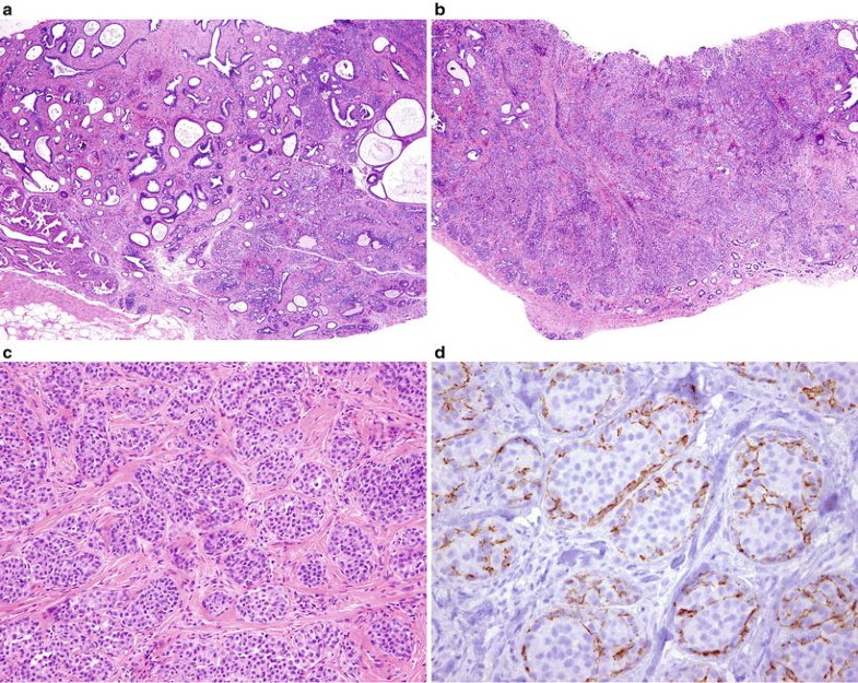 Adenosis, Sclerosing Lesions, Microglandular Adenosis, and Mucocele ...