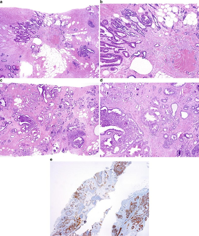 Adenosis, Sclerosing Lesions, Microglandular Adenosis, and Mucocele ...