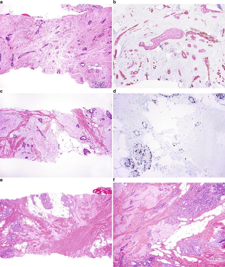 Adenosis, Sclerosing Lesions, Microglandular Adenosis, and Mucocele ...