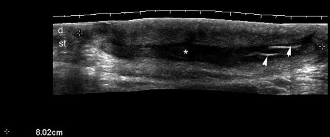 Ultrasound of the Subcutaneous Tissue | SpringerLink