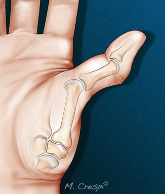 The Rheumatoid Thumb | SpringerLink