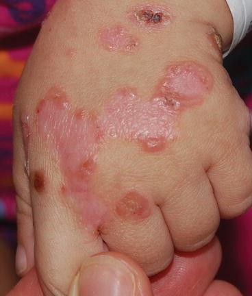 Autoimmune Blistering Diseases in Children | SpringerLink