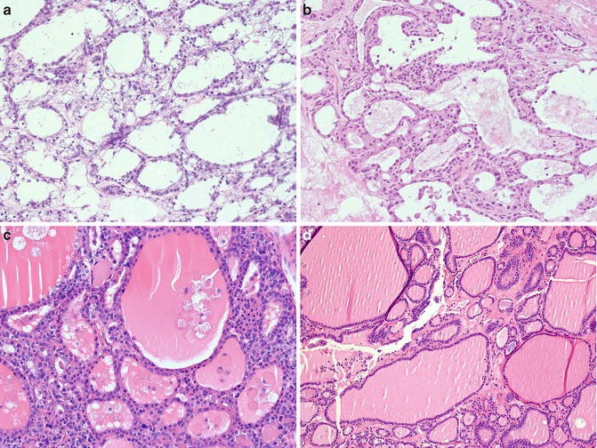 Parathyroid Pathology | SpringerLink