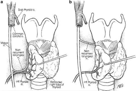 Complications of Parathyroid Surgery | SpringerLink