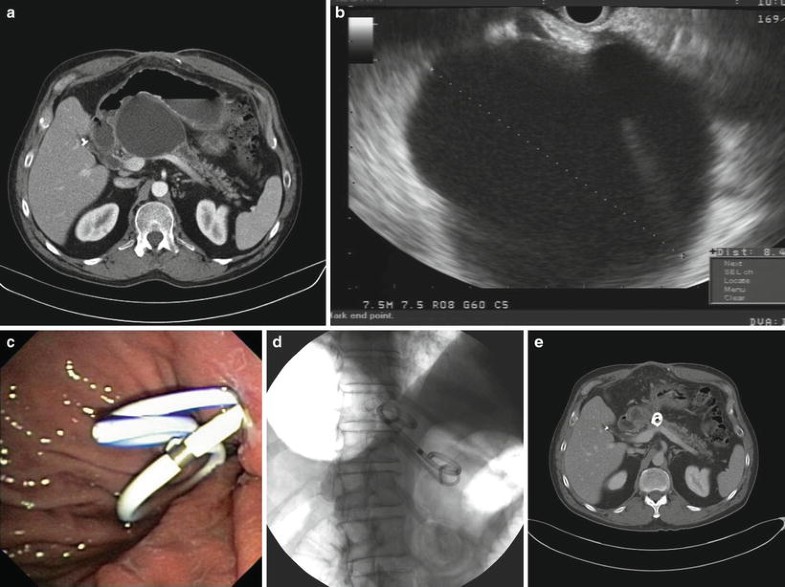 Endoscopic Drainage of Pancreatic Fluid Collections | SpringerLink