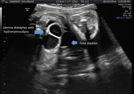 Diagnostic Approach to Müllerian Anomalies | SpringerLink