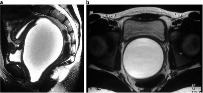 Imperforate Hymen | SpringerLink