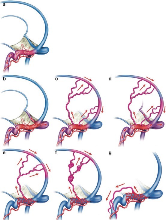 Cranial Dural AV Fistulas: Making Sense of Who to Treat and How ...