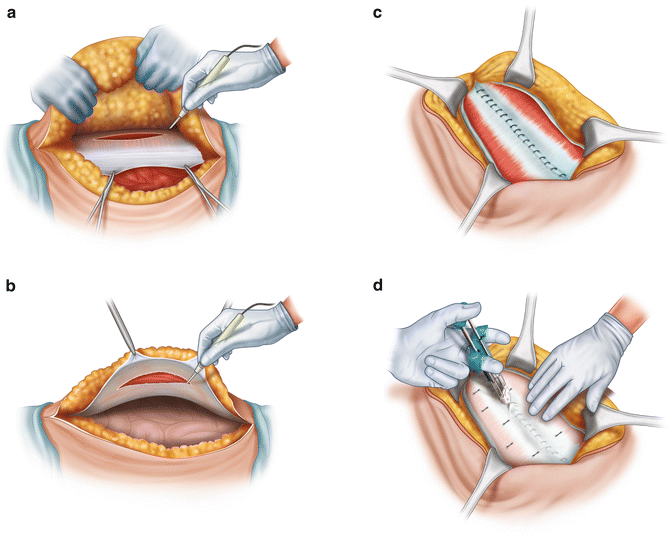 Onlay Ventral Hernia Repair | SpringerLink