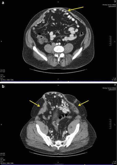 Open Anterior Component Separation | SpringerLink