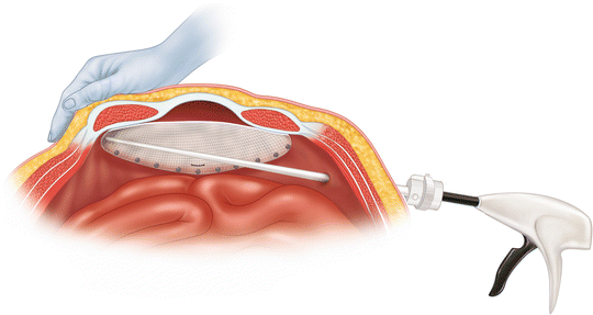 Laparoscopic Ventral Hernia Repair | SpringerLink