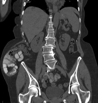 Laparoscopic Repair of Flank Hernias | SpringerLink