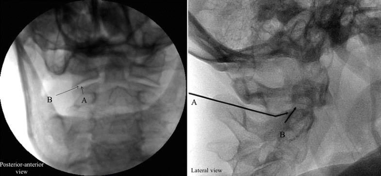 Greater Occipital Nerve Entrapment | SpringerLink