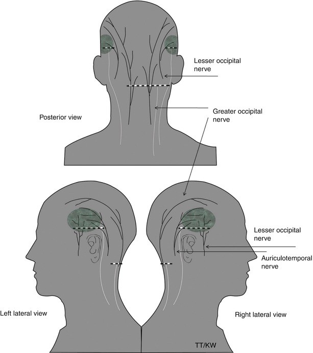 Greater Occipital Nerve Entrapment | SpringerLink