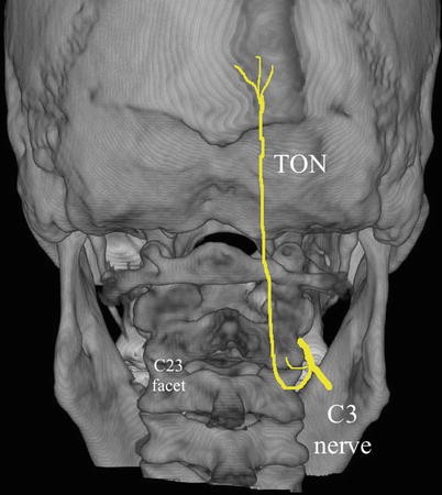 Third Occipital Nerve Entrapment | SpringerLink