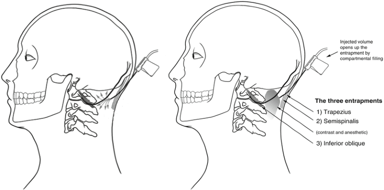 Suboccipital Neuralgia and Decompression | SpringerLink