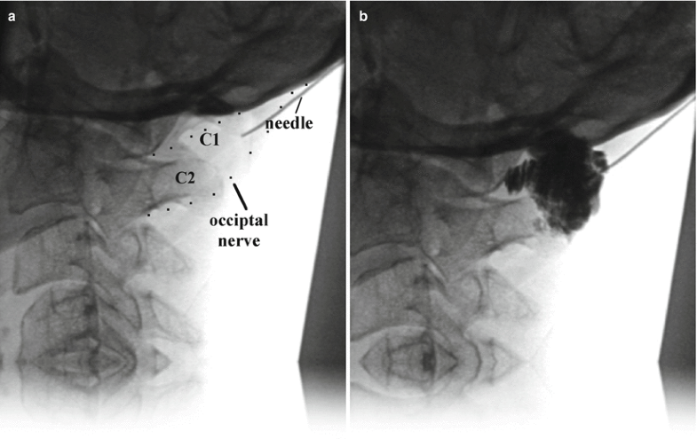 Suboccipital Neuralgia and Decompression | SpringerLink
