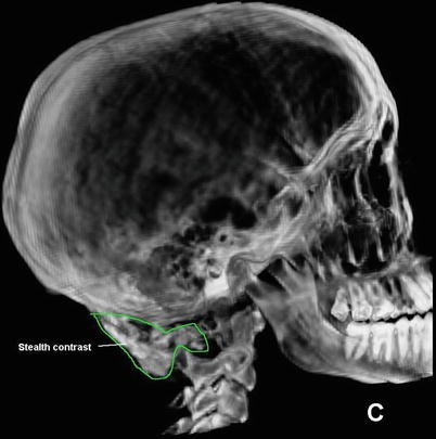 Suboccipital Neuralgia and Decompression | SpringerLink