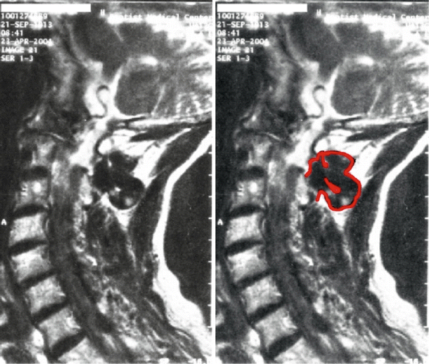 Suboccipital Neuralgia and Decompression | SpringerLink