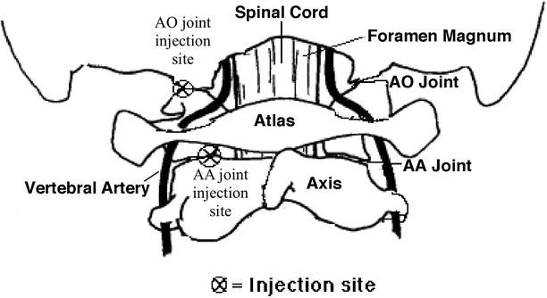 Suboccipital Neuralgia and Decompression | SpringerLink