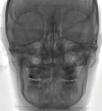 Infraorbital Nerve Entrapment | SpringerLink