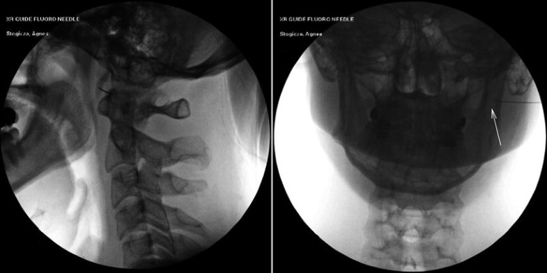 Spinal Accessory Nerve Entrapment | SpringerLink
