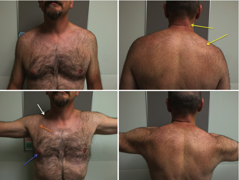 Spinal Accessory Nerve Entrapment | SpringerLink