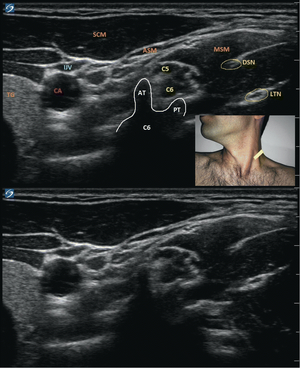 Long Thoracic Nerve Entrapment | SpringerLink