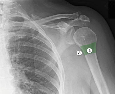 Axillary Nerve Entrapment | SpringerLink