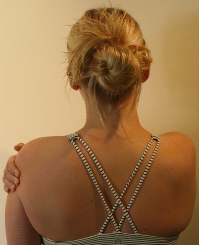 Axillary Nerve Entrapment | SpringerLink