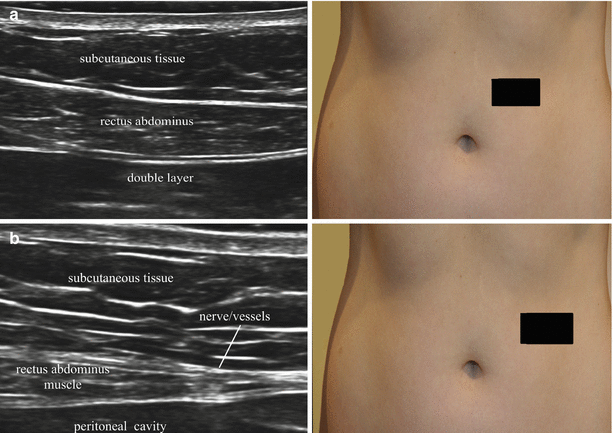 Abdominal Cutaneous Nerve Entrapment Syndrome | SpringerLink