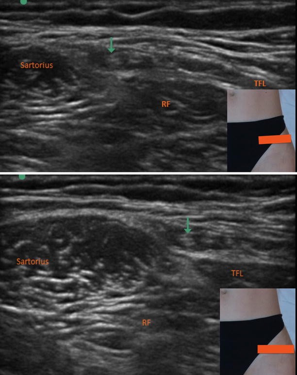 Lateral Femoral Cutaneous Nerve Entrapment | SpringerLink