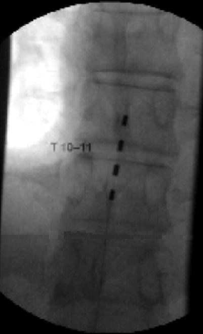 Lateral Femoral Cutaneous Nerve Entrapment | SpringerLink