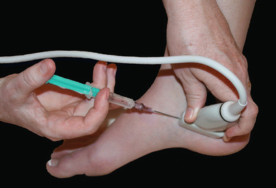 Medial Calcaneal Nerve Entrapment | SpringerLink