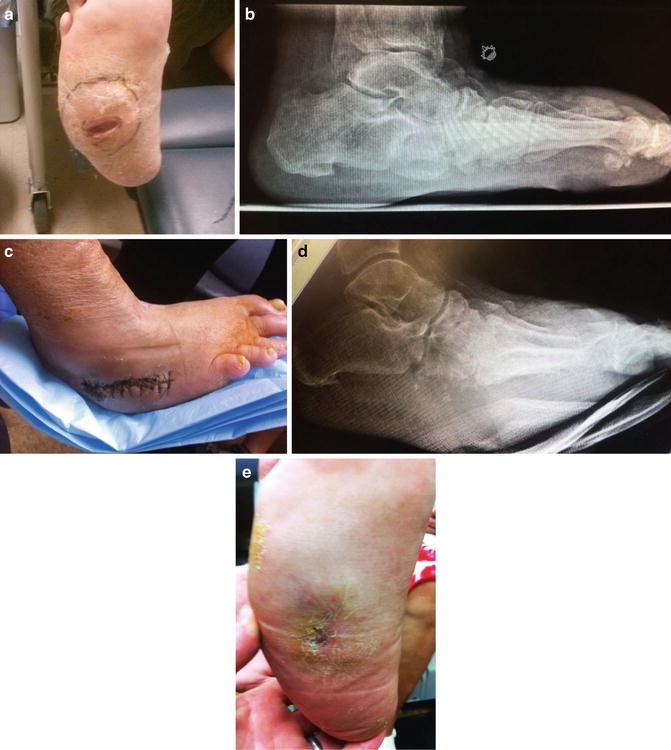 Exostectomy for Charcot Arthropathy | SpringerLink