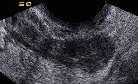 Pelvic Inflammatory Disease and Tubo-Ovarian Abscesses | SpringerLink