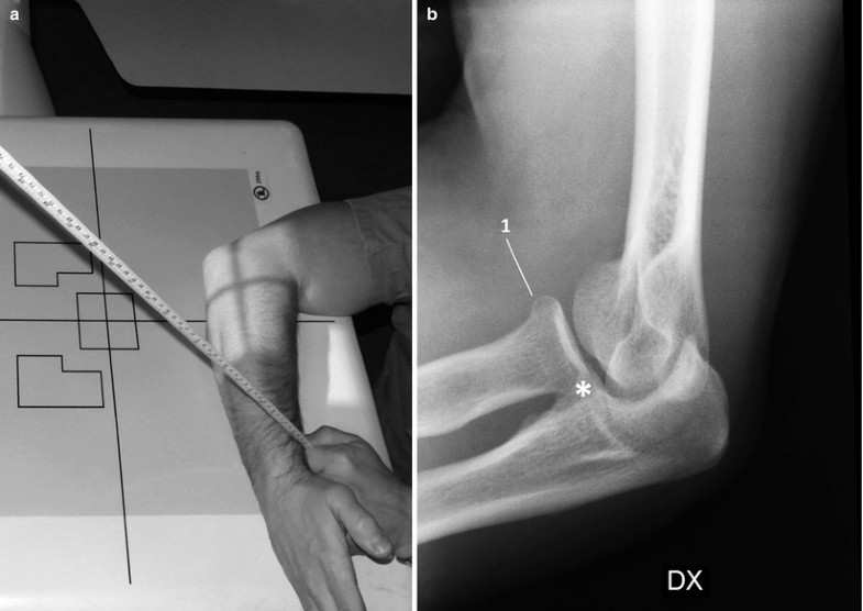 Approach to the Radiological Imaging of the Elbow | SpringerLink