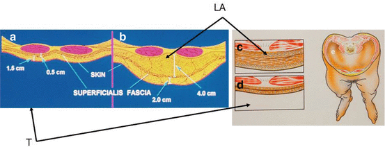 Anatomy of the Abdominal Panniculus | SpringerLink