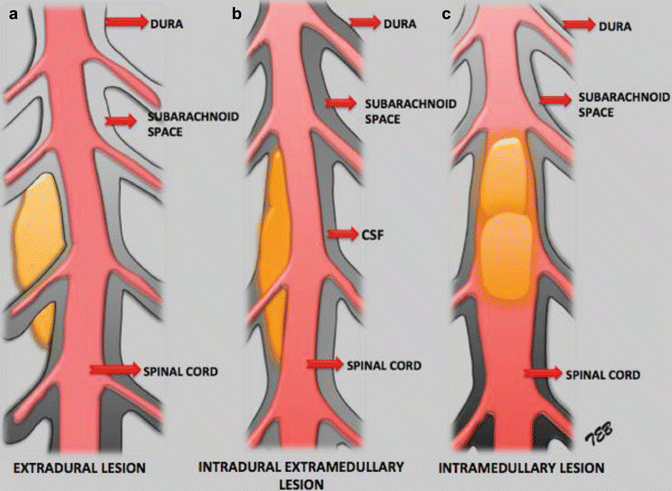 Spinal Cord Compression | SpringerLink