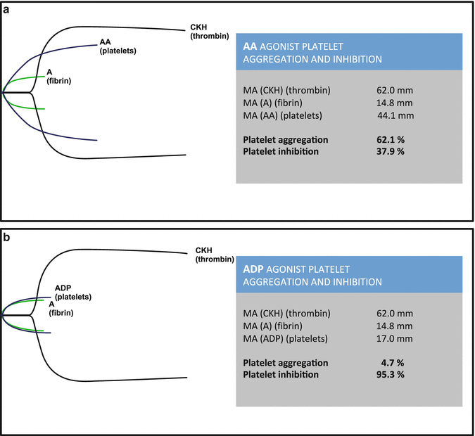 Thrombelastography (TEG®) | SpringerLink