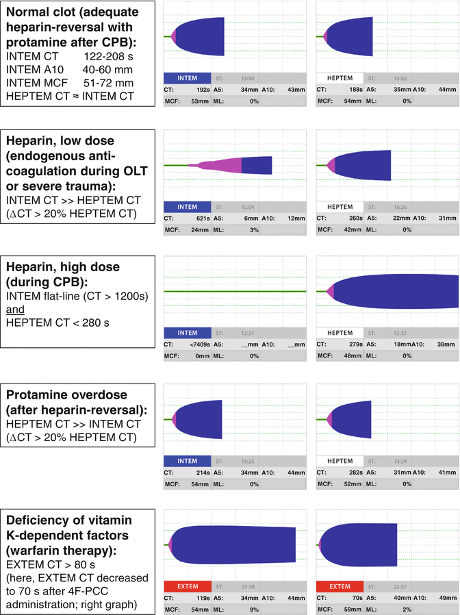 Rotational Thromboelastometry (ROTEM®) | SpringerLink