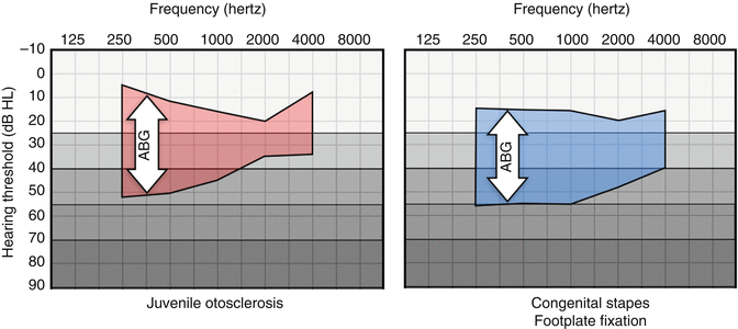 Congenital Stapes Fixation | SpringerLink