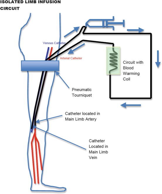 Isolated Limb Perfusion for Melanoma | SpringerLink