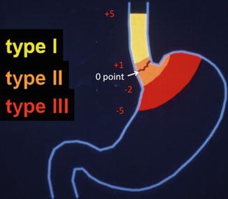 Siewert Classification of Adenocarcinoma of the Esophagogastric ...