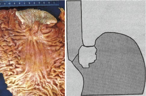 Siewert Classification of Adenocarcinoma of the Esophagogastric ...