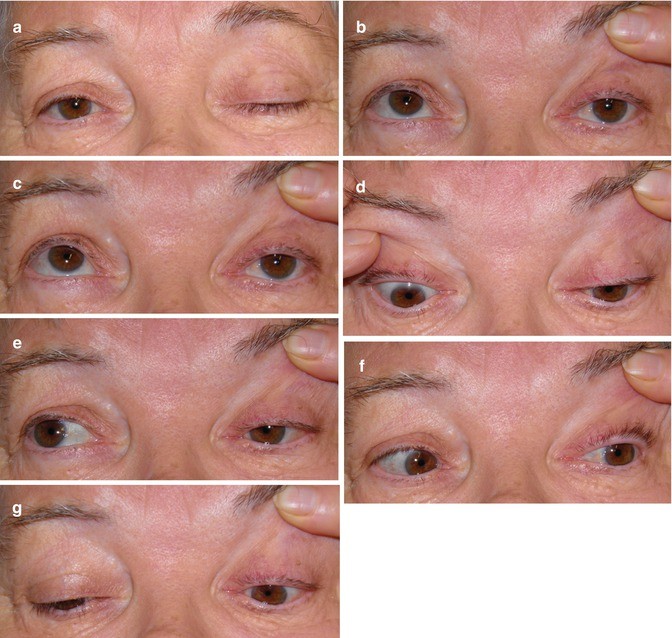 The Ocular Characteristics and Differential Diagnostics of Mixed Types ...