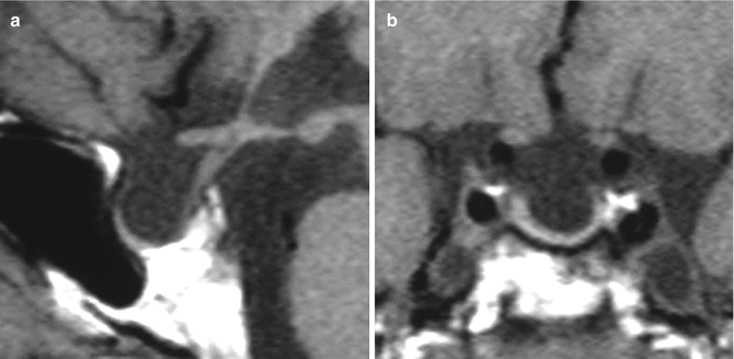 Sheehan Syndrome | SpringerLink