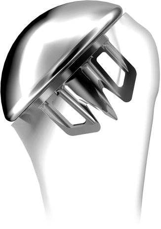 Stemless Humeral Head Replacement | SpringerLink
