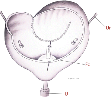 Selecting Patients for Continent or Incontinent, Heterotopic or ...